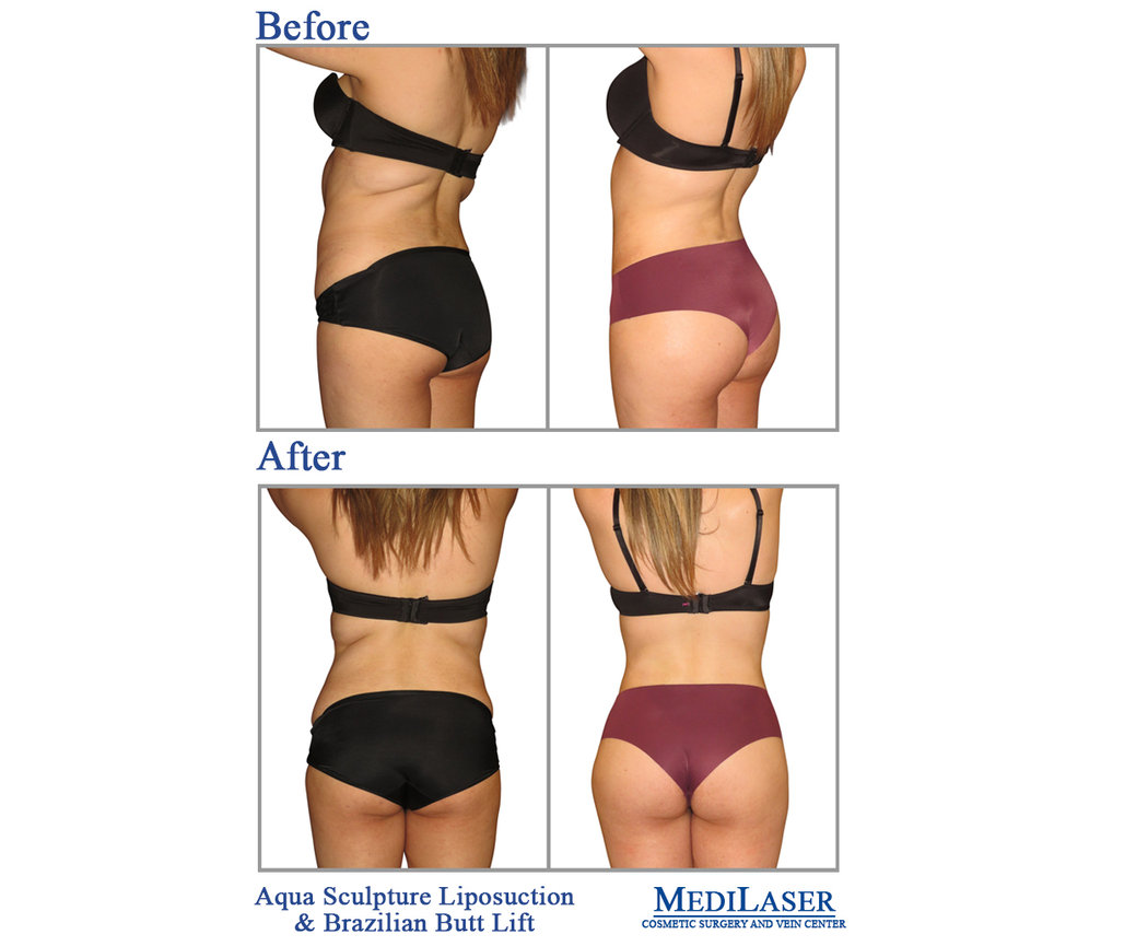 BBL Before and After - Medilaser Surgery and Vein Center