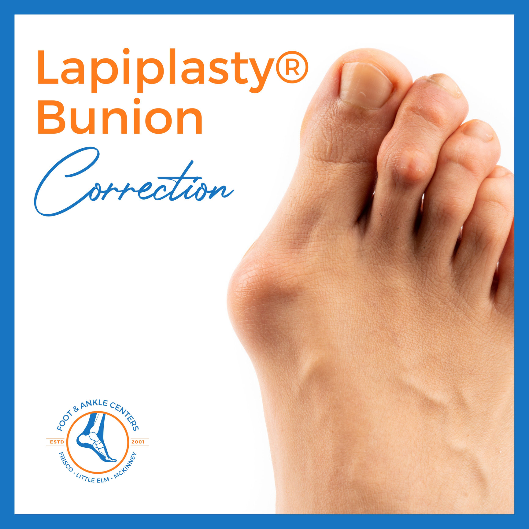 Bunion Surgery in Frisco, Little Elm, & McKinney - Foot & Ankle Centers ... Bunion Surgery in Frisco, Little Elm, & McKinney - Foot & Ankle Centers ...