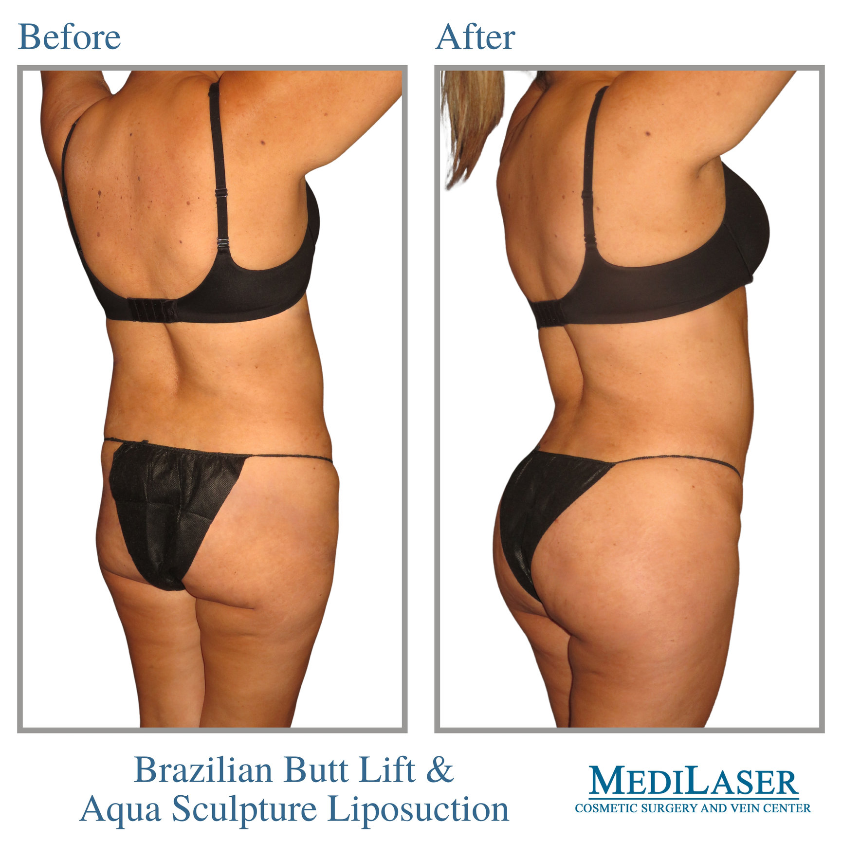 BBL Before & After | Medilaser | Frisco, TX