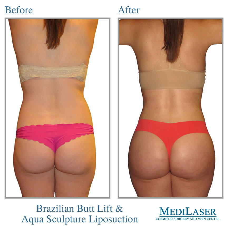 BBL Before & After | Medilaser | Frisco, TX
